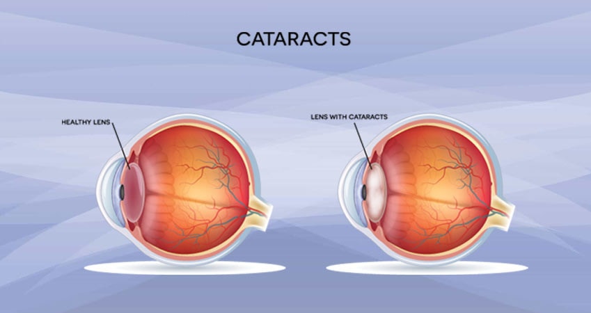What You Need to Know About Cataracts | Florida Eye Specialists