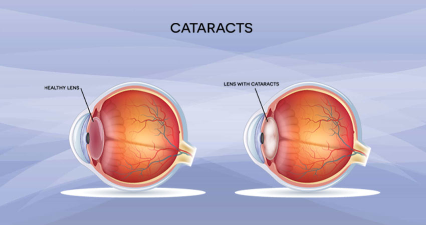 What You Need to Know About Cataracts | Florida Eye Specialists